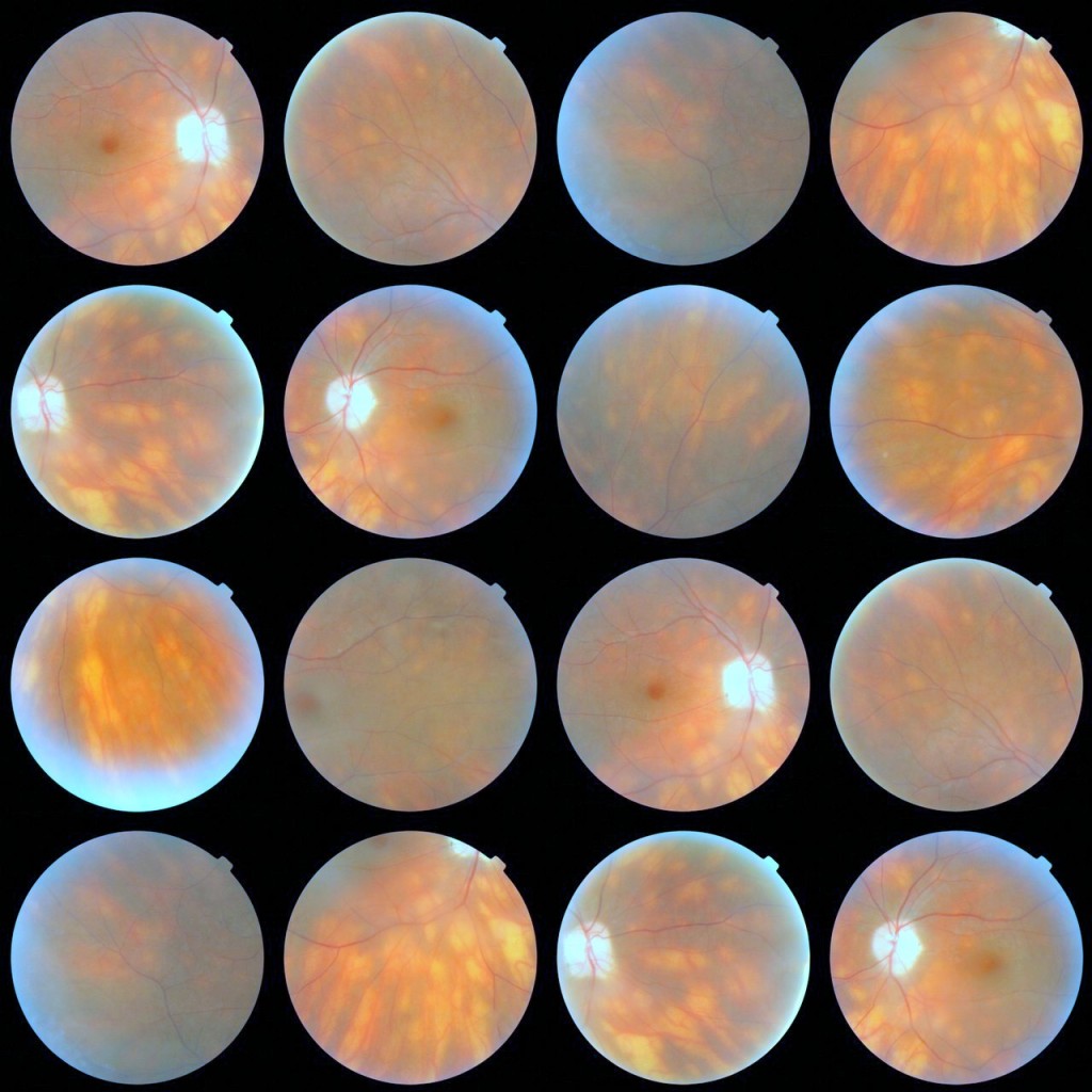 collage | Birdshot Uveitis Society